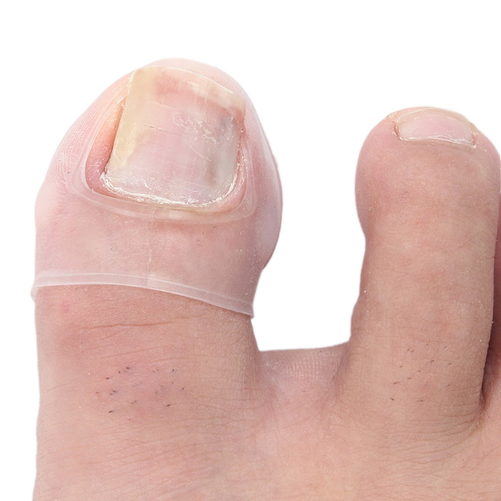 Ingrown Toenail Correction Silicon Cover - 4 Pack – BetterToes